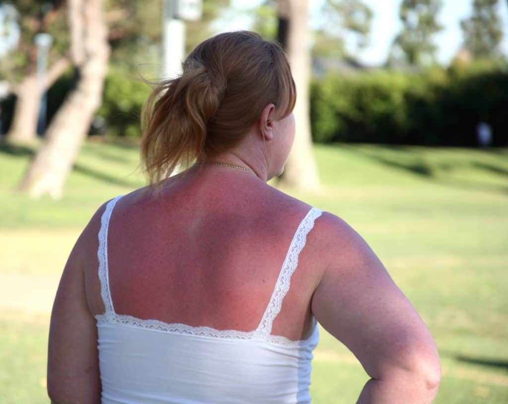 sunburn woman - Radiation Safety Institute of Canada
