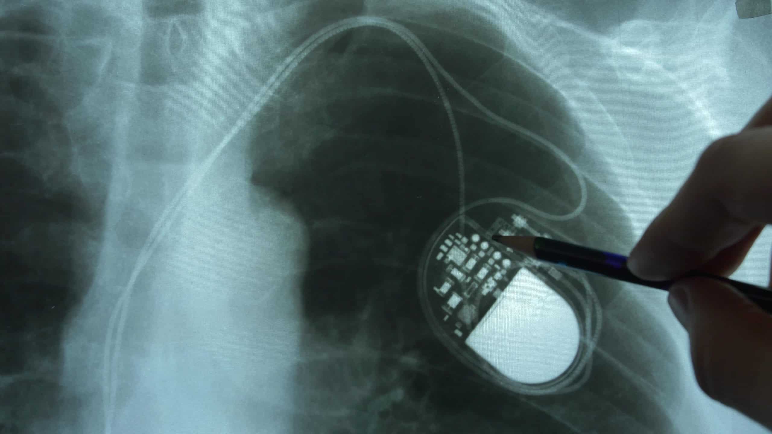 Doctor,Examining,X-ray,Image,Of,Chest,With,Artificial,Cardiac,Pacemaker ...