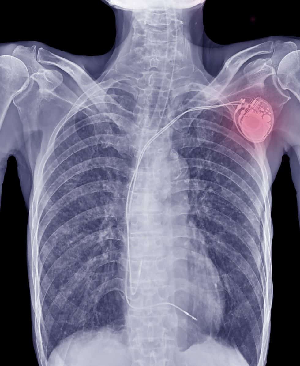 EMF Exposure Standards for Pacemaker Wearers - Radiation Safety ...
